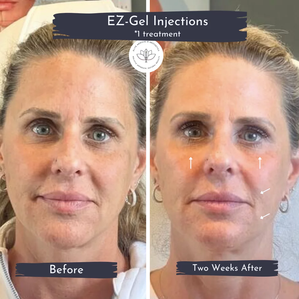EZ Gel 101 | Elite Medical & Aesthetics | Lone Tree, CO 80124